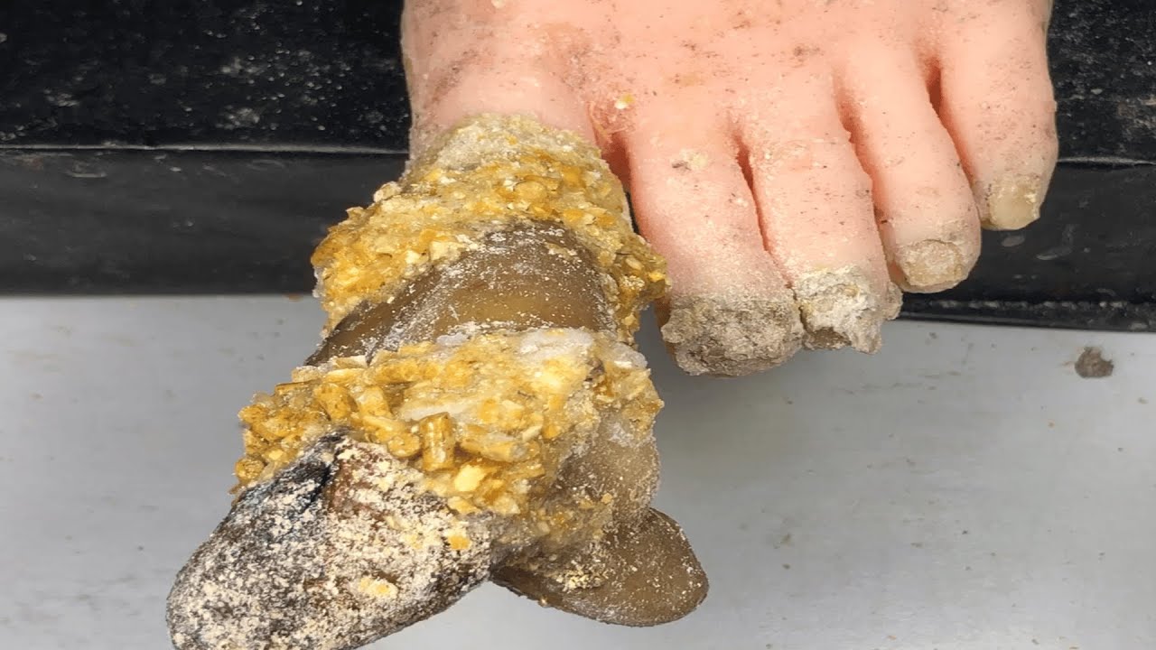 Onychomycosis arches into a bridge, perfectly trimming the fungus ...