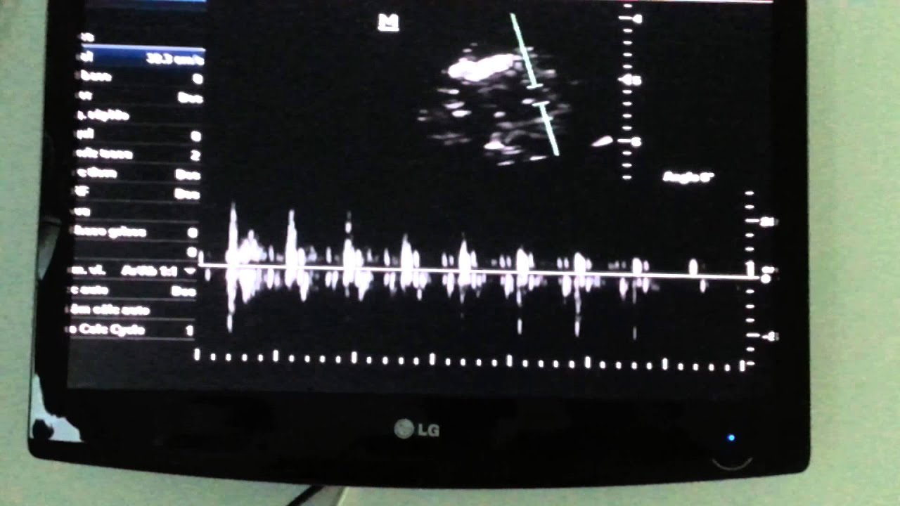 Eco semana 12+6 (2) - YouTube