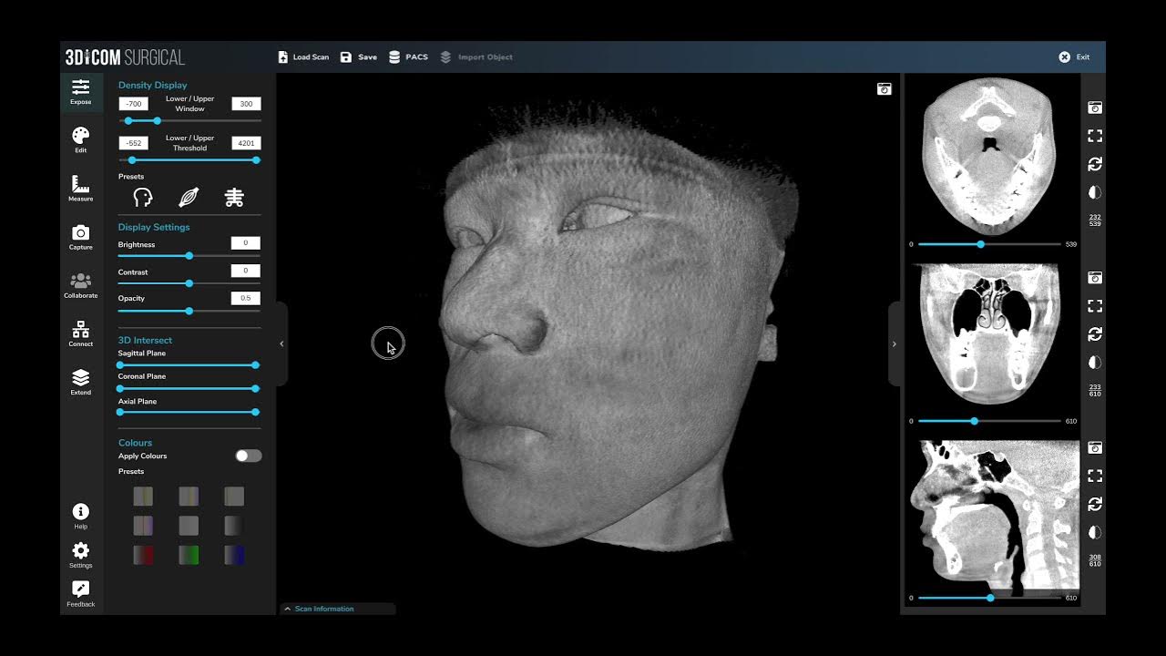 Virtually Cut Into Patients With 3Dicom Lite - Interactive 3D Dicom Viewer - YouTube