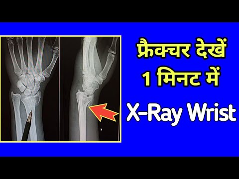 Fracture Distal Radius (Case-5) | Wrist X-Ray | Fracture Radius Styloid ...