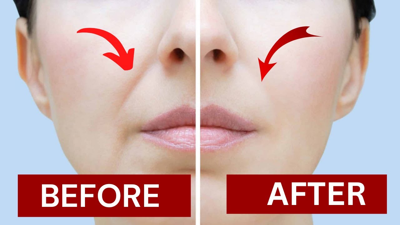 ৭ দিনে মুখের বলিরেখা ও বয়সের ছাপ দূর করার সহজ উপায় - SMILE LINES ...