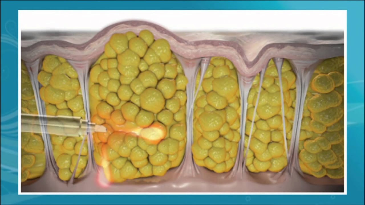 How to Get Rid of Cellulite - YouTube