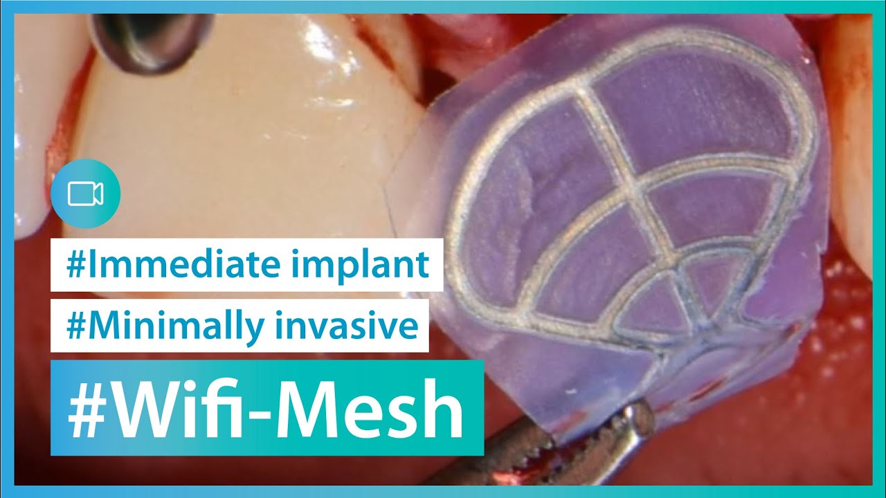 Immediate implant placement & Minimally invasive horizontal ridge ...