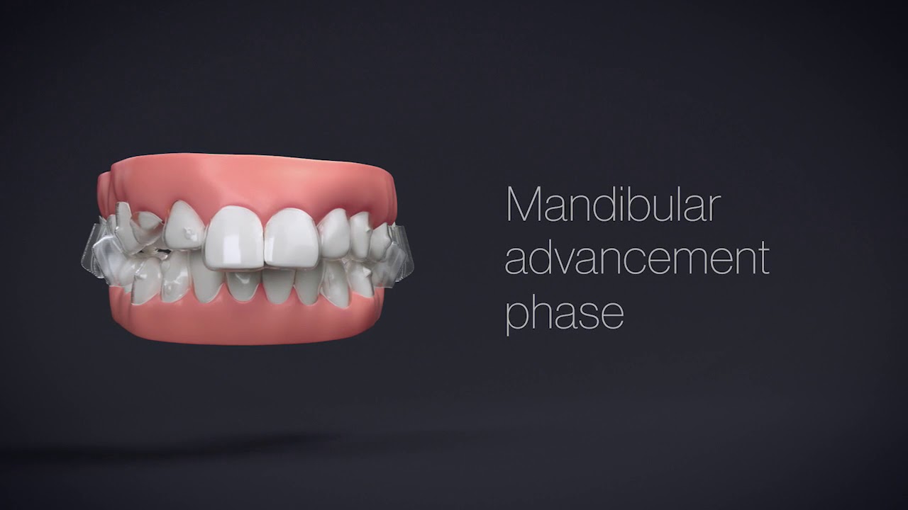 Invisalign Treatment with Mandibular Advancement 11 - YouTube