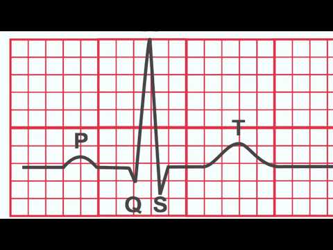 What Does A Bad Electrocardiogram Look Like