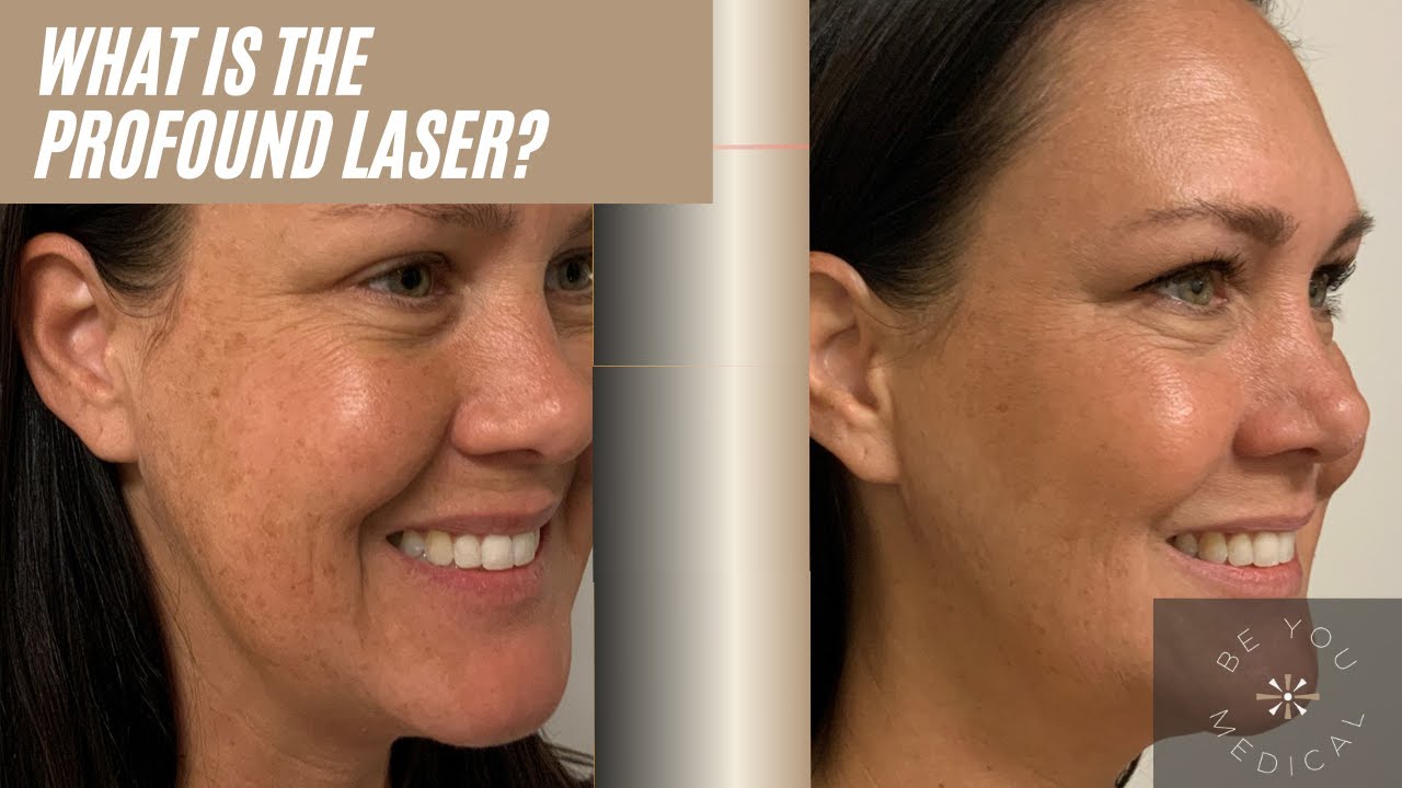 What is the Profound Laser? - YouTube