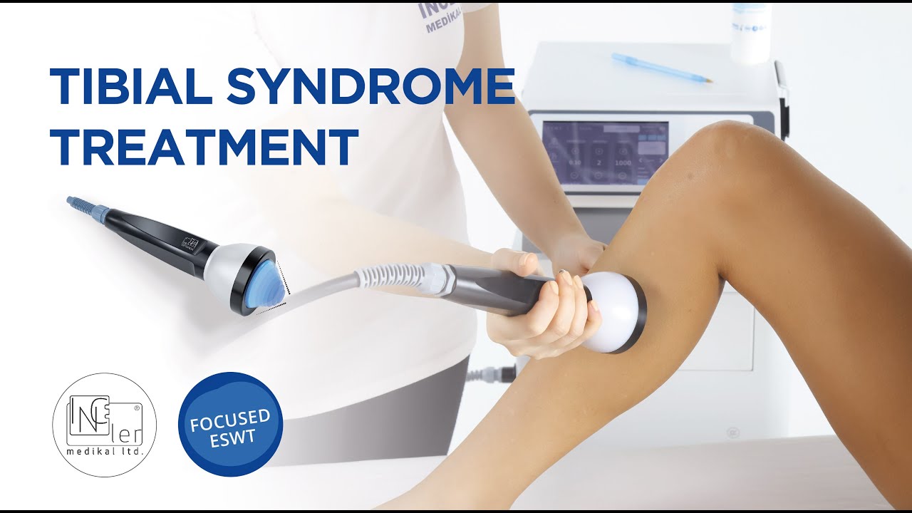 Focused Shockwave Therapy - Tibial Syndrome - YouTube