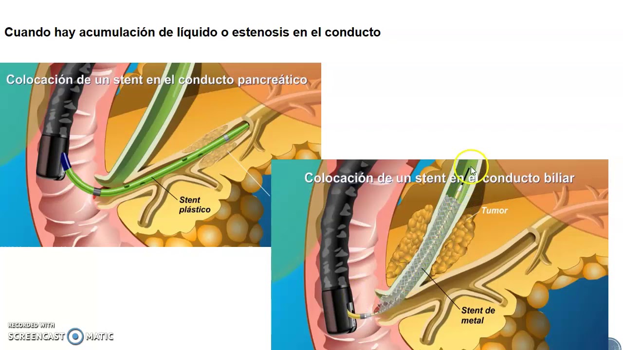 Complicaciones de CPRE - YouTube