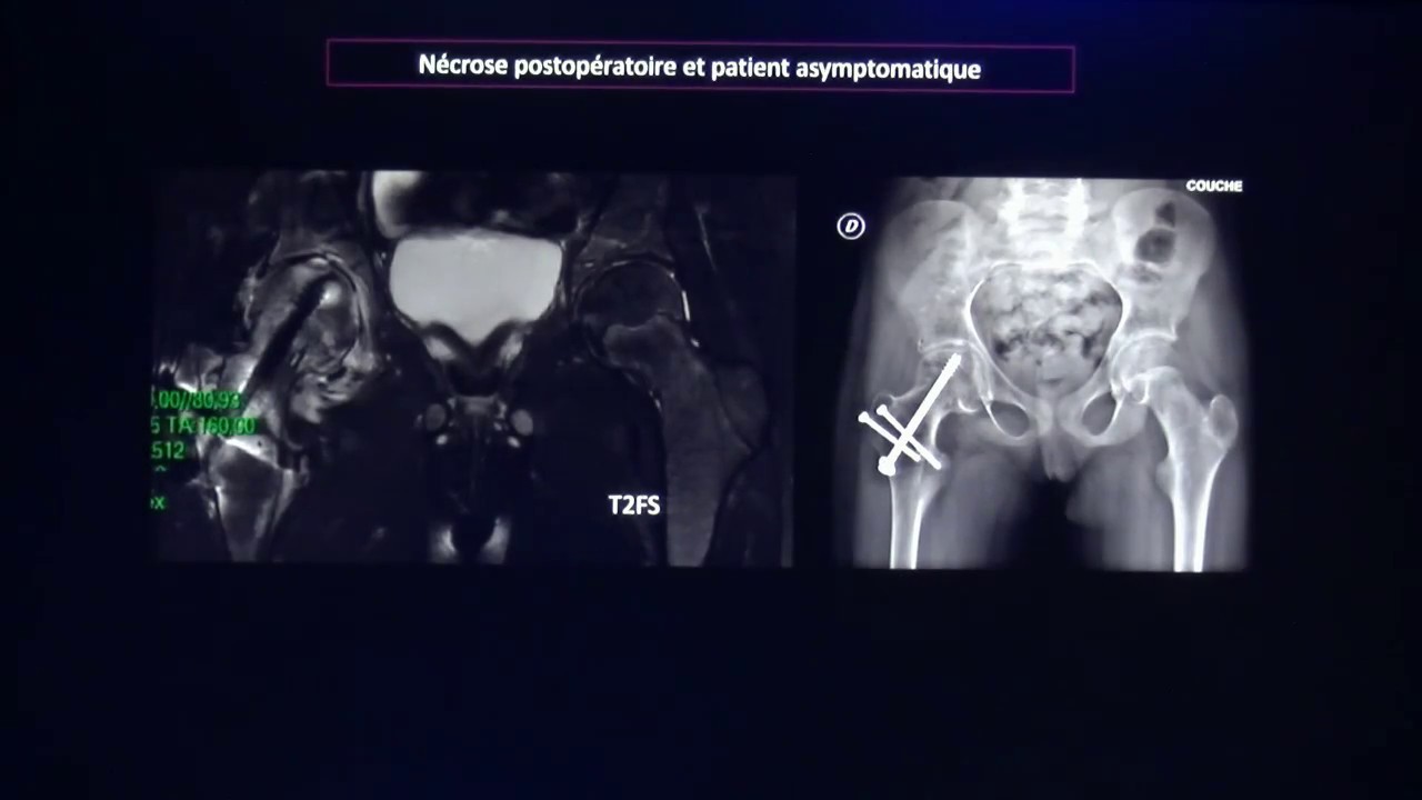 Epiphysiolyse fémorale proximale - Traitement chirurgical - YouTube