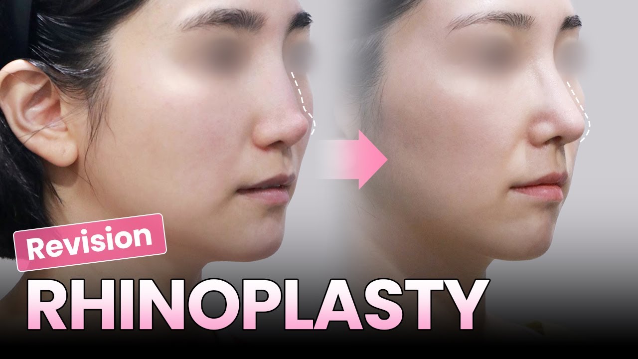 Botched Nose Revision Rhinoplasty Results | MINE Plastic Surgery - YouTube