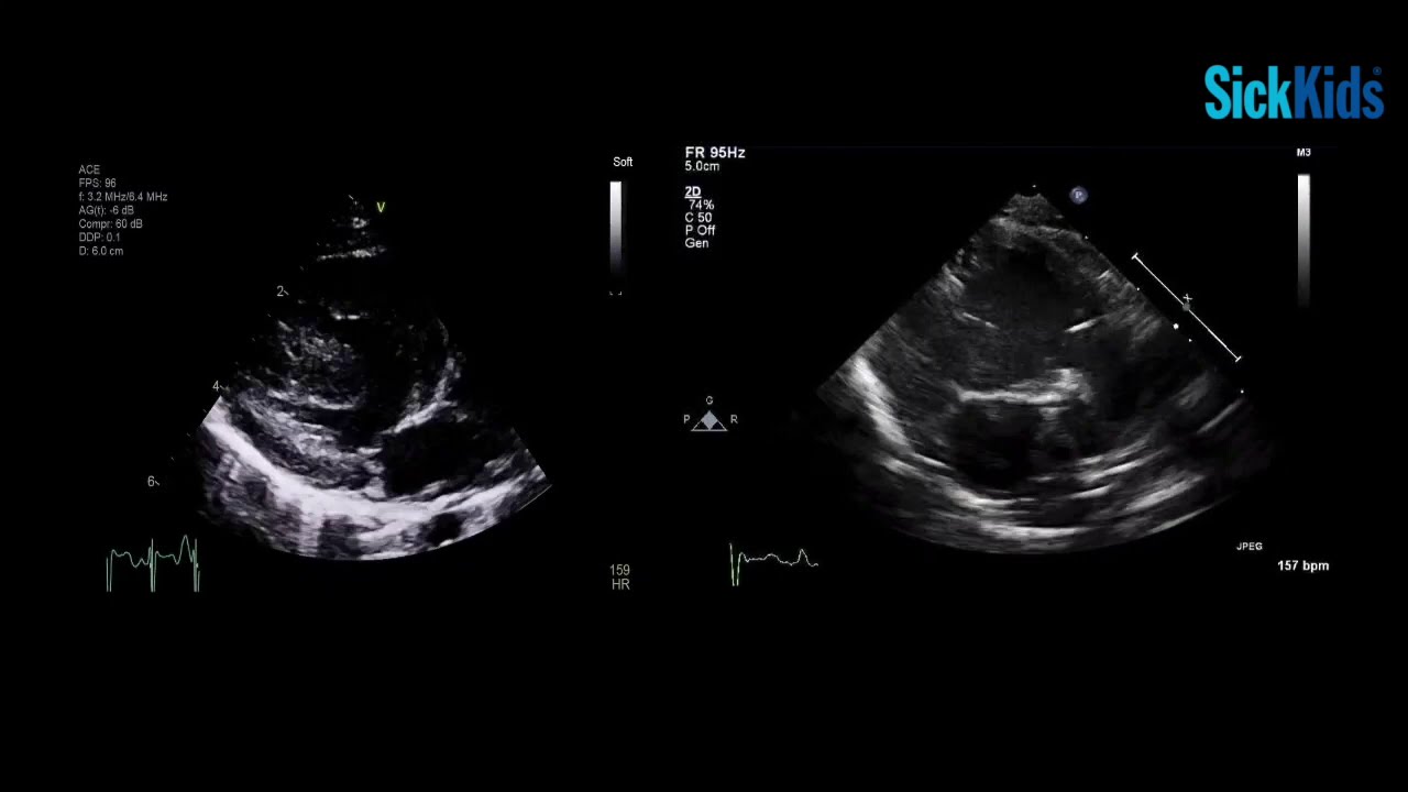 Right Ventricle to Pulmonary Artery Graft Palliation of PDA-dependency ...
