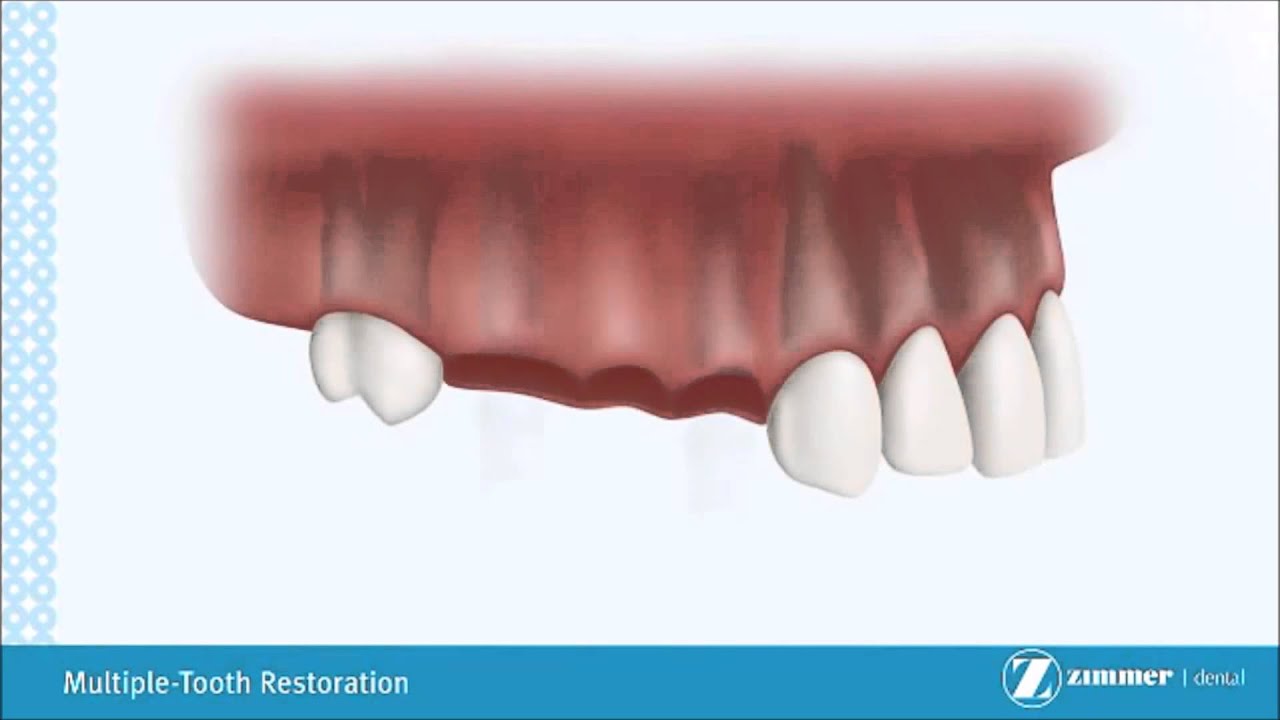 Multiple Tooth Restauration - Dental Implant - Medellin Dental ...