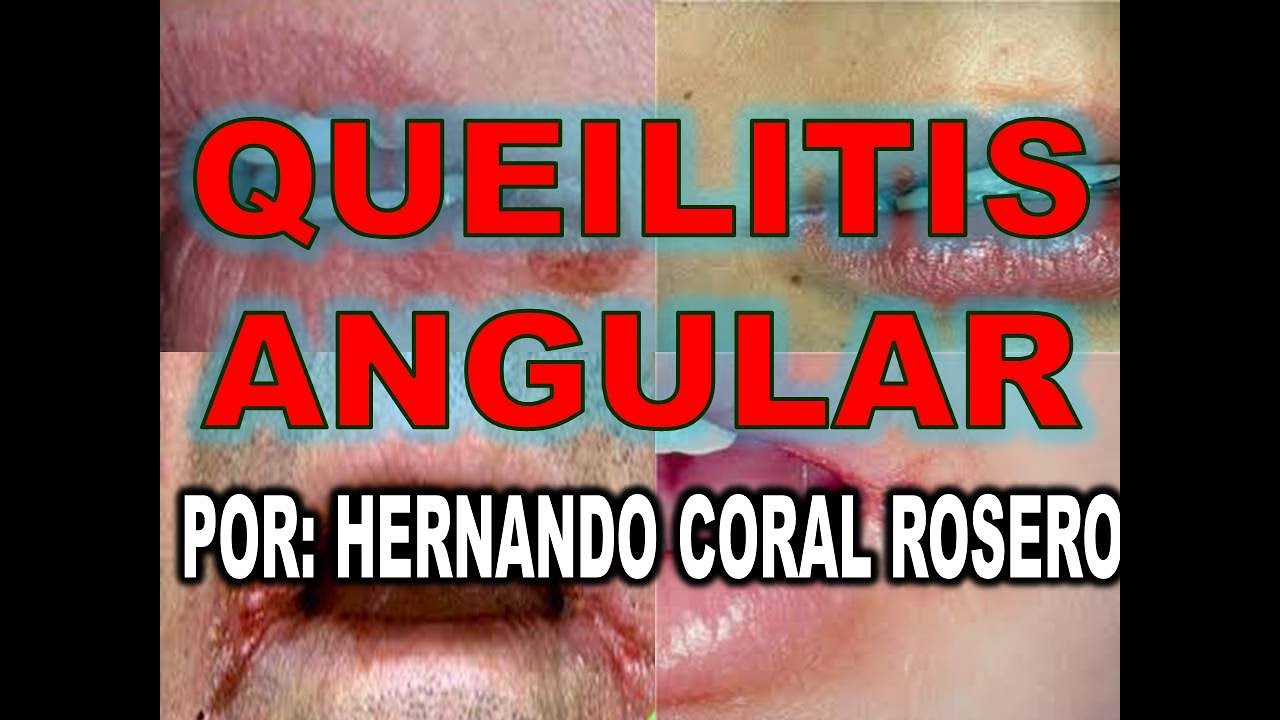 QUEILITIS ANGULAR Inflamación en la comisura labial, fisura, úlceras ...