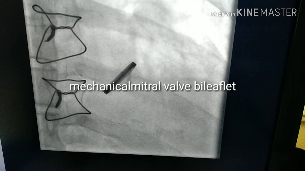 Mechanical heart valve: Bileaflet heart valve in mitral valve in ...