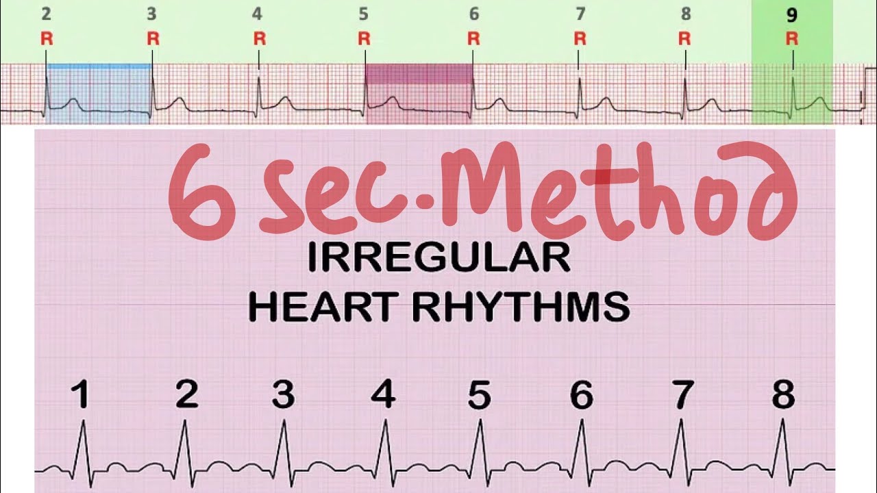 ECG Heart Rate Calculation In Irregular Rhythm 6 Second Method YouTube ECG Heart Rate Calculation In Irregular Rhythm 6 Second Method YouTube