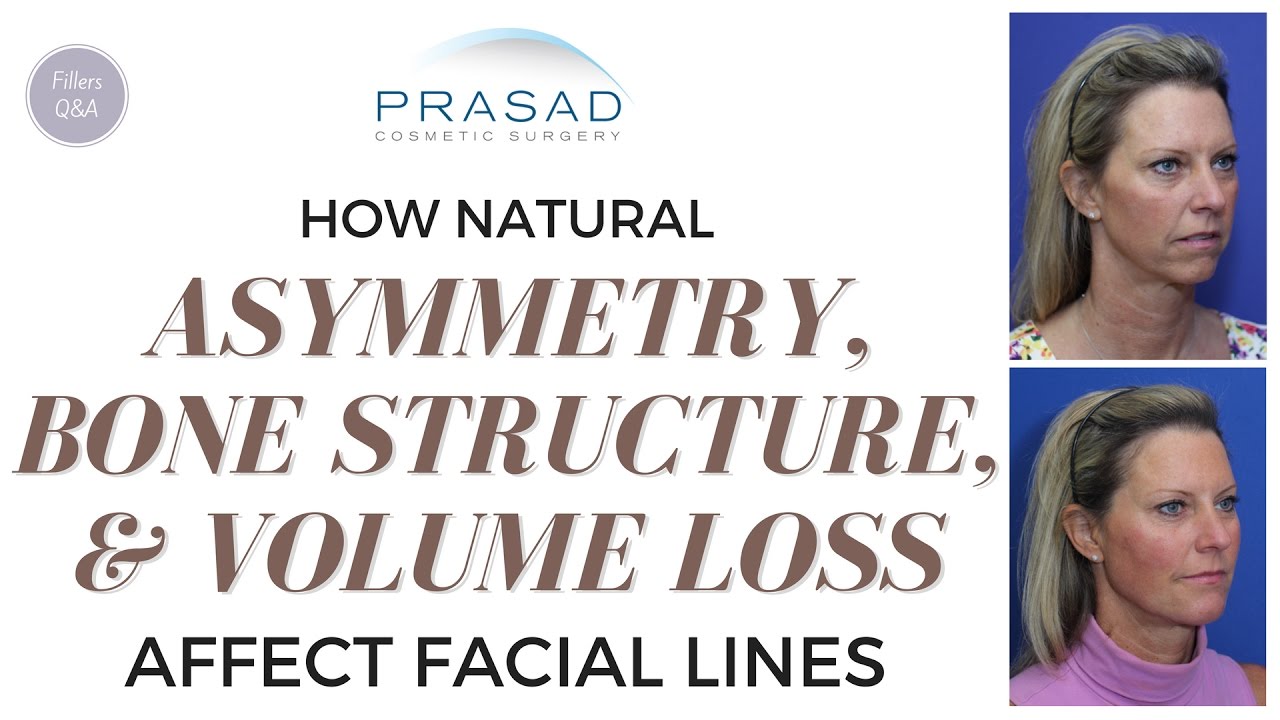 How Bone Structure can Cause Facial Lines in Young People, and ...