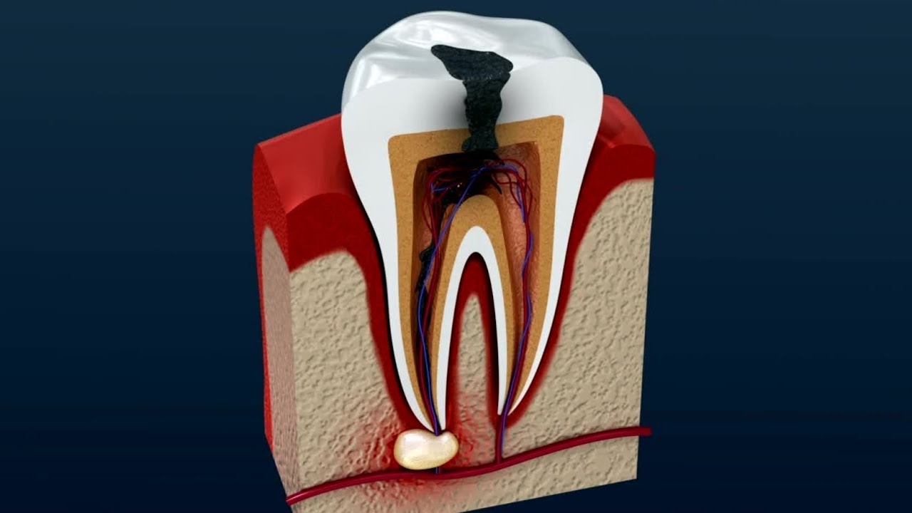 What Is Root Canal What Are The Benefits YouTube What Is Root Canal What Are The Benefits YouTube