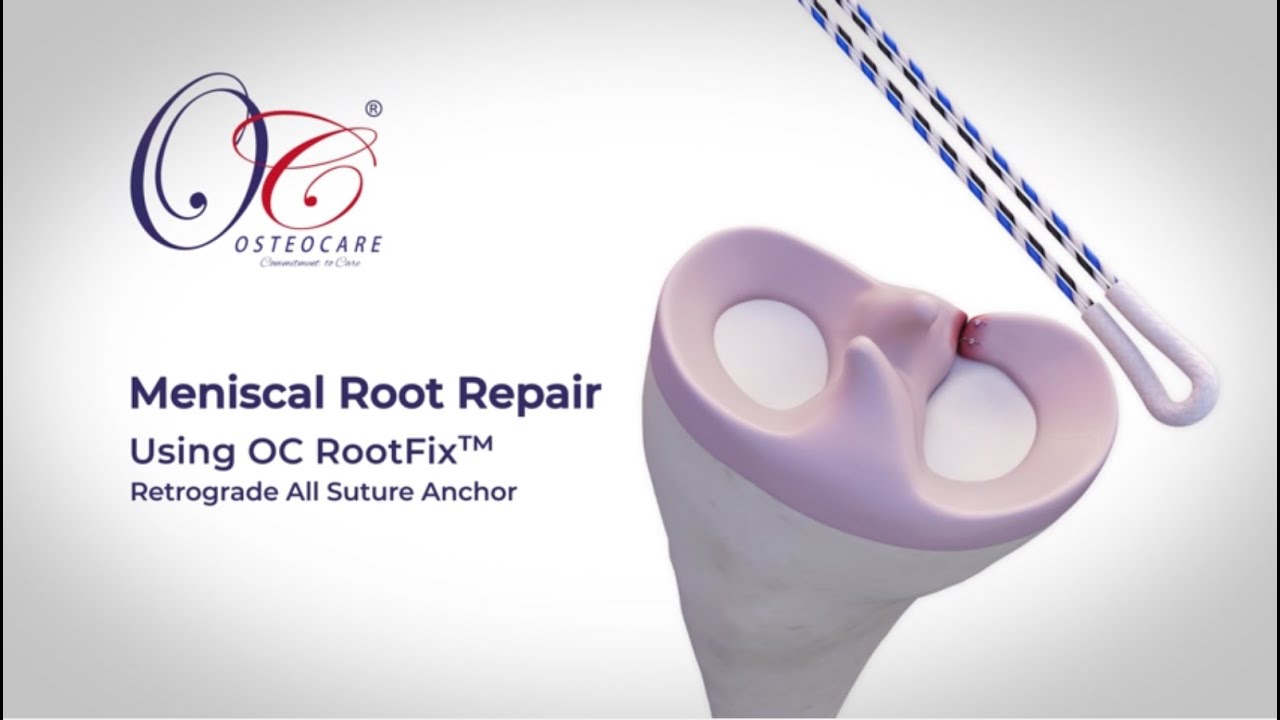 Meniscus Root Repair | RootFix™ All Suture Anchor | Osteocare Medical ...