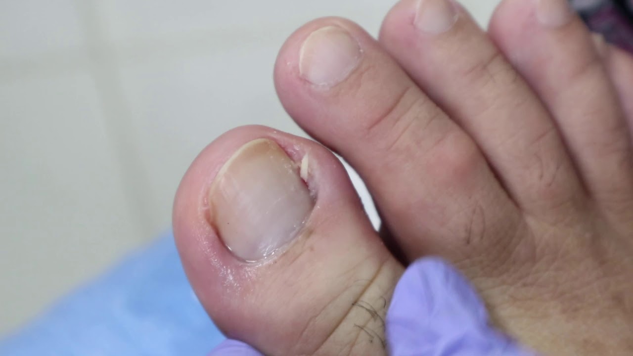 Ep_723 Ingrown toenail removal 👣 ป๊าเห็นดาวเลย 😆 (This video clip from ...