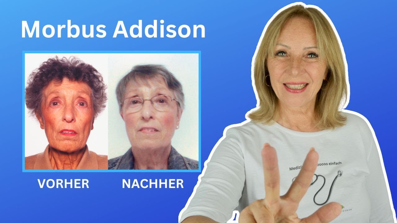 Diagnose - Morbus Addison: 3 Ursachen, die du kennen musst! | Dr ...