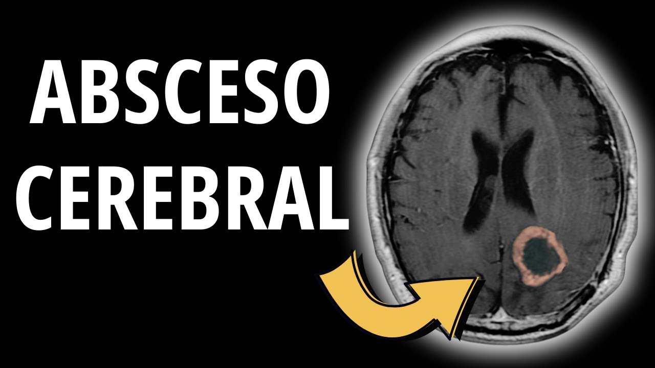 Absceso Cerebral Explicado Claramente - YouTube