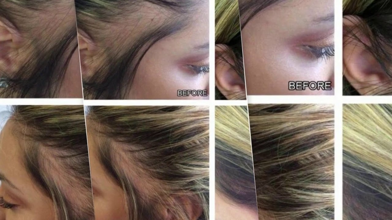 Scalp Roll-on Hair Growth - YouTube