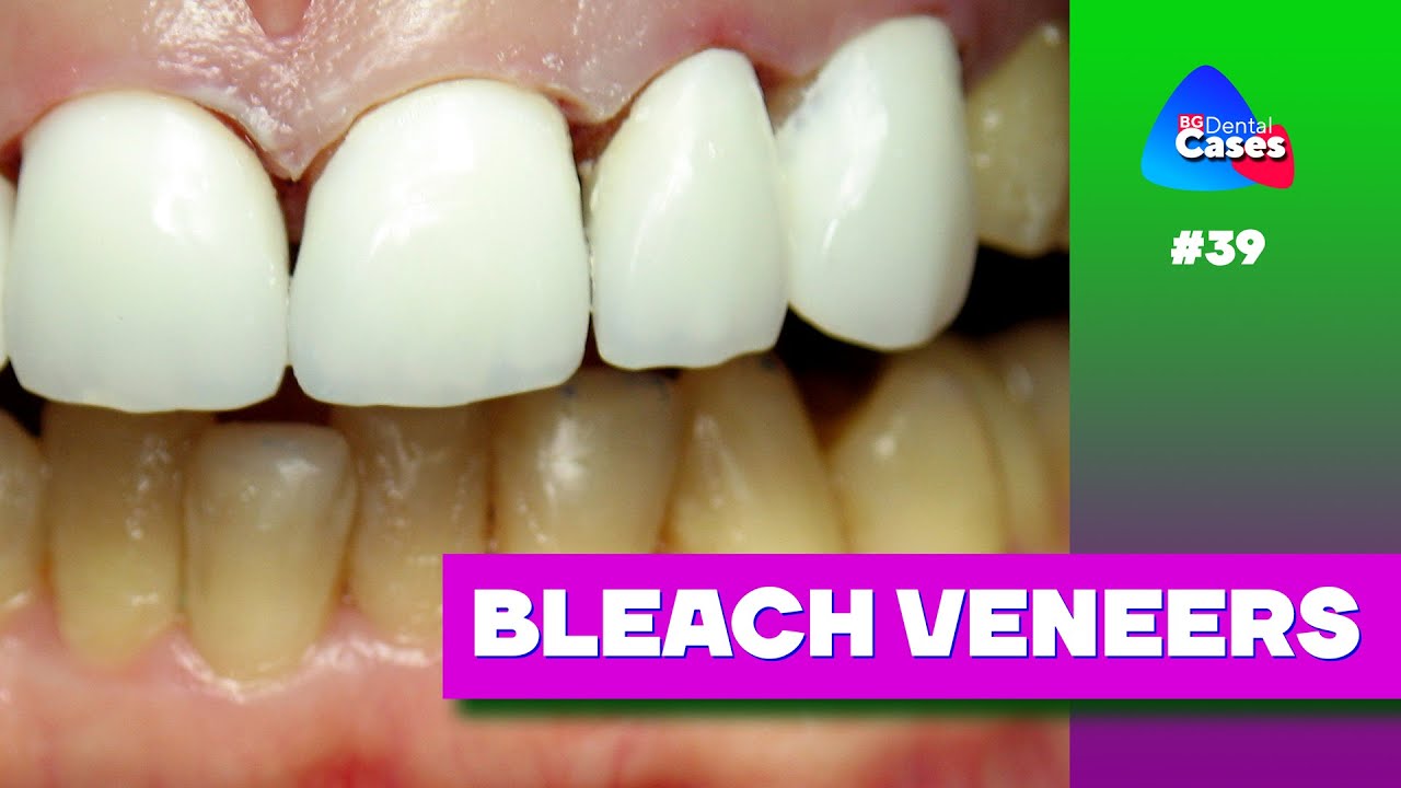 Bleach veneers | BG Dental Cases #39 - YouTube