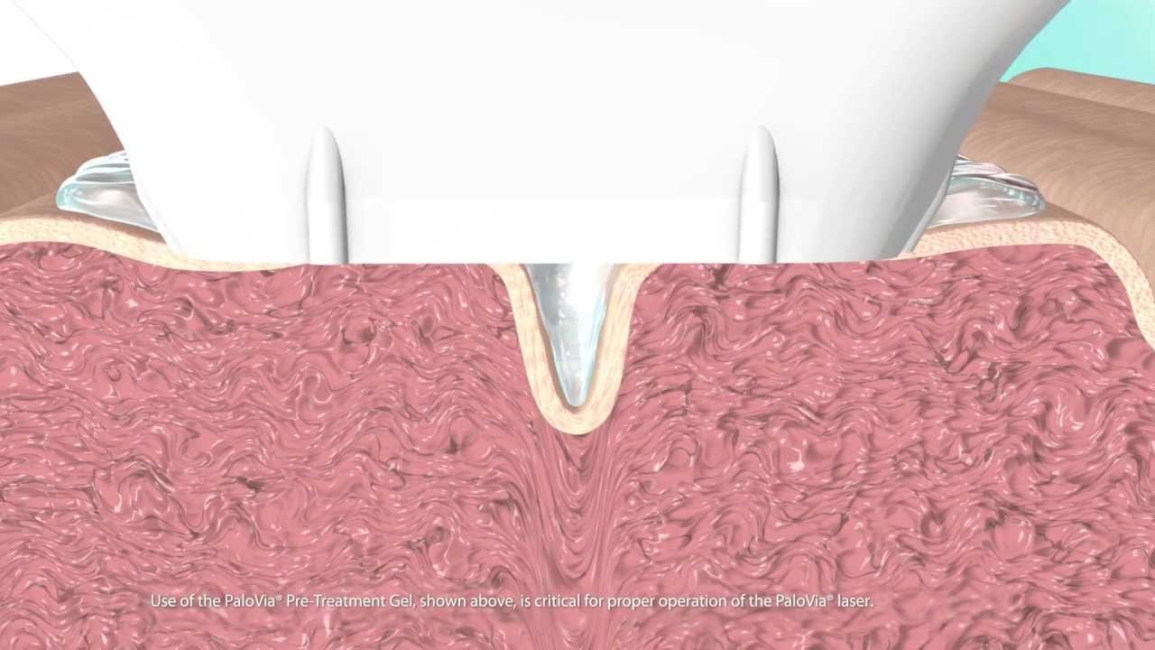 PaloVia Skin Renewing Laser - How It Works Below The Surface - YouTube