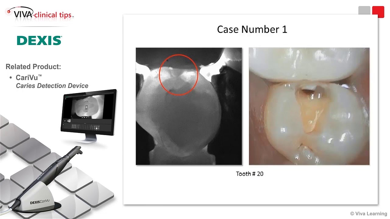 Pinpointing Interproximal Decay & Incipient Caries—with Dr. Lester ...