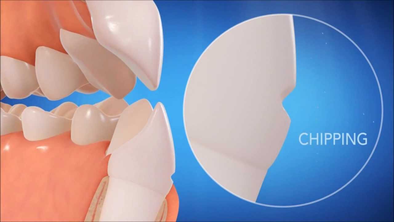 How Invisalign can help protect your bite and total health - YouTube