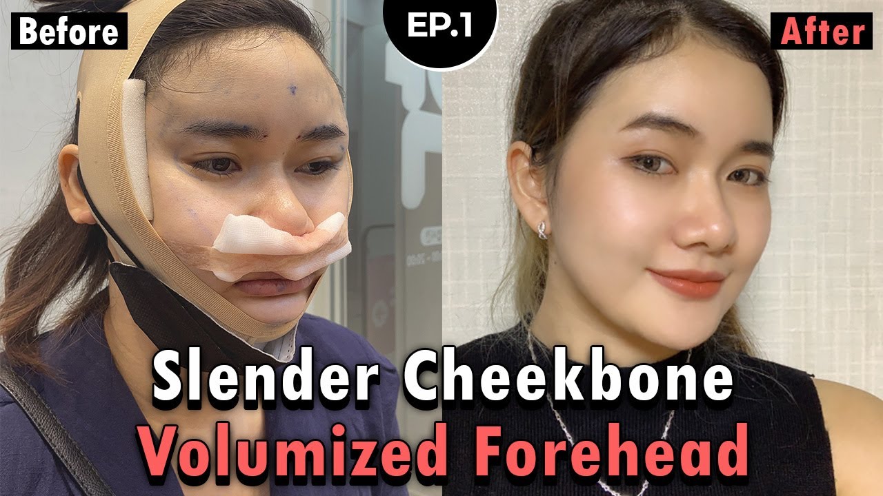 [SUB] Quick Cheekbone Reduction & Facial Fat Grafting Surgery in Korea ...