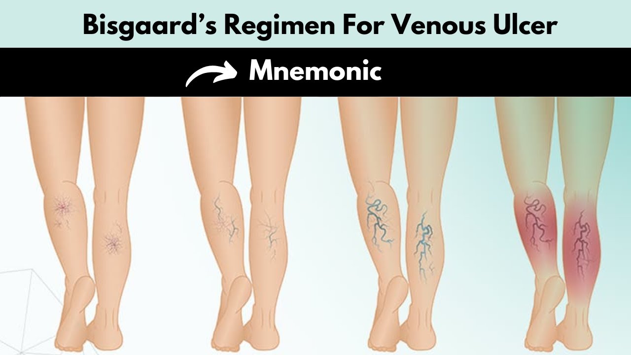Bisgaard’s Regimen For Venous Ulcer With Mnemonic | Dr Mubashar Ata ...