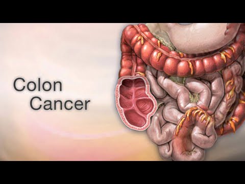 Live demonstration of Colonoscopy procedure in a patient with Colon ...