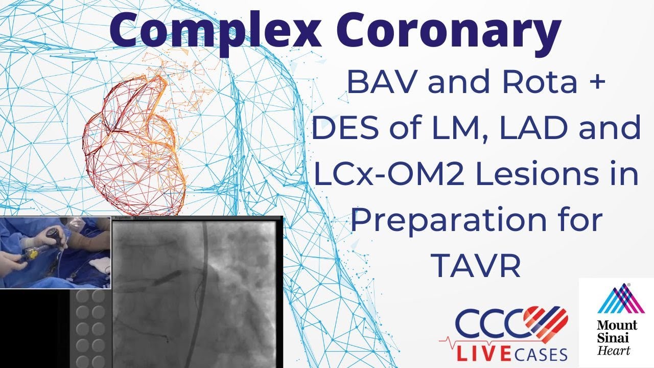 BAV and Rota + DES of LM, LAD and LCx-OM2 Lesions in Preperation for ...