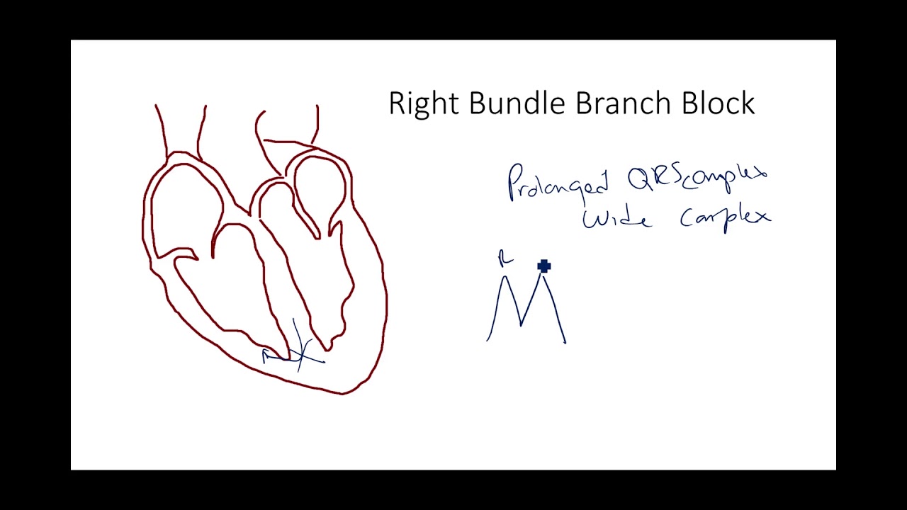 Module 7-Conduction Blocks |EKG Fundamentals Series - YouTube