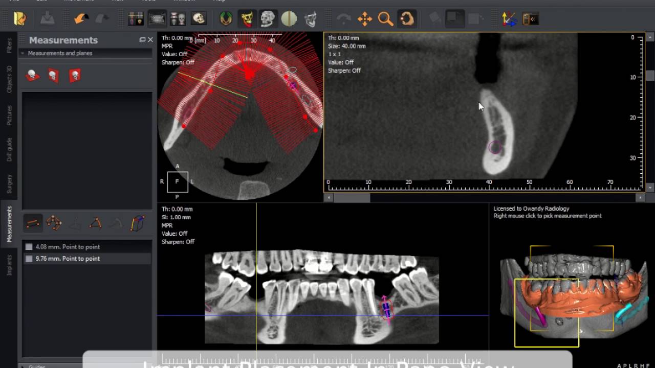 QuickVision 3D - Implant create and place - OWANDY RADIOLOGY - YouTube