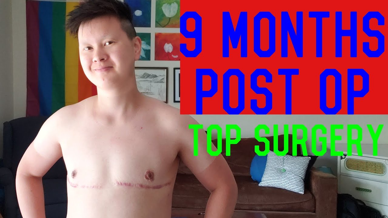 Top Surgery Results 9 Months Post Op Non Binary Trans Masc Youtube