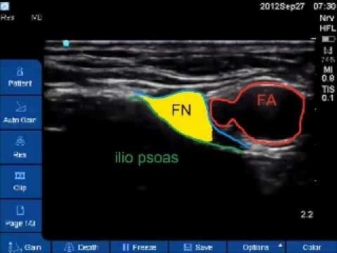 US guided femoral nerve block - YouTube