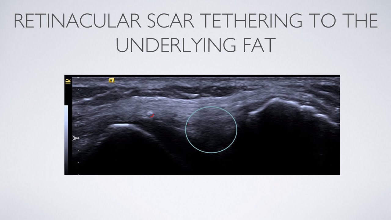 Dr Delzell Research Presentation of Patellar Retinaculum Ultrasound ...