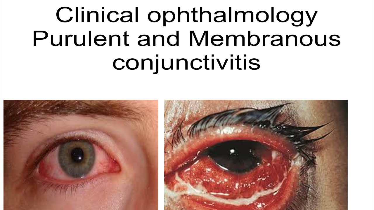 Clinical ophthalmology BACTERIAL CONJUNCTIVITIS in easiest way part2 ...