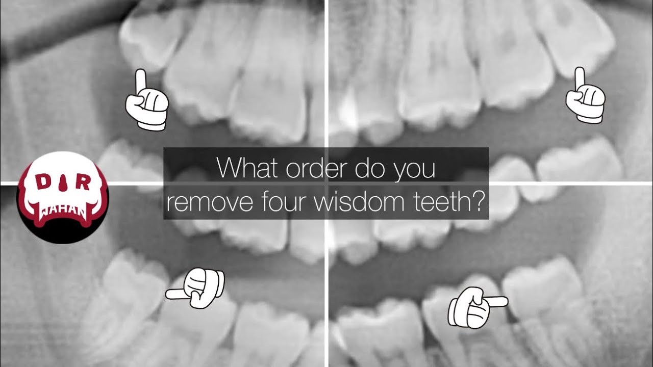 What order do you Remove Wisdom Teeth? - YouTube