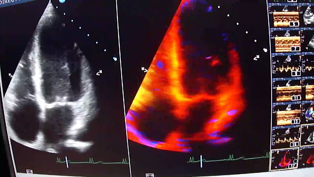 Doppler Tisular Color - YouTube