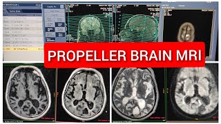 Propeller Brain MRI scan protocol positioning and plann... | Doovi