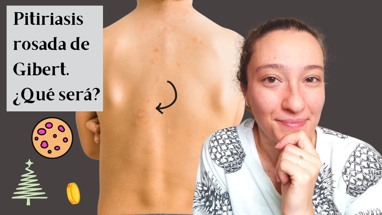 🪙PITIRIASIS ROSADA de Gibert en niños y adultos 🤷 - YouTube