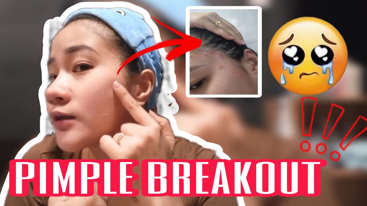 MY PIMPLE BREAKOUT STORY | TREATMENT FOR PIMPLE BREAKOUT - YouTube