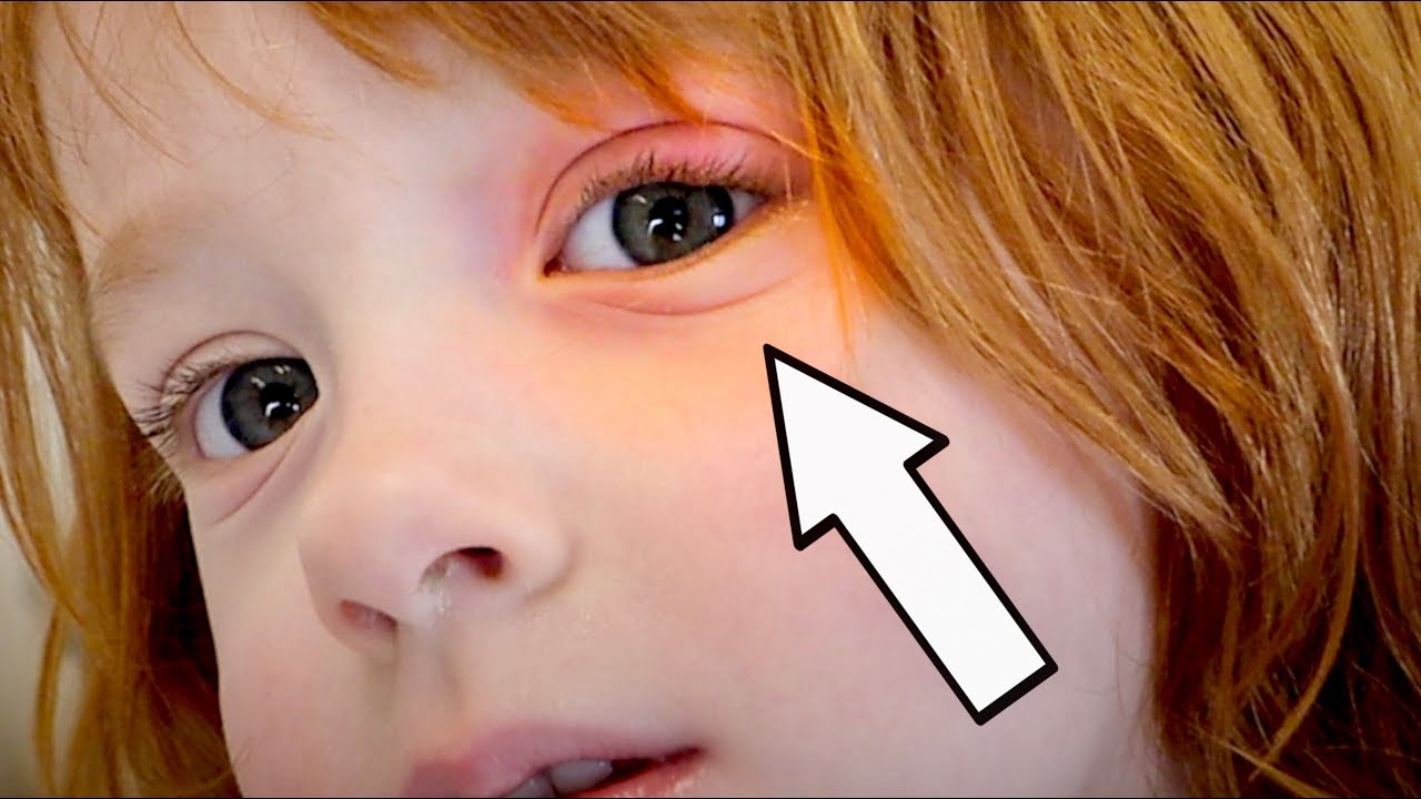 Periorbital Cellulitis Contagious