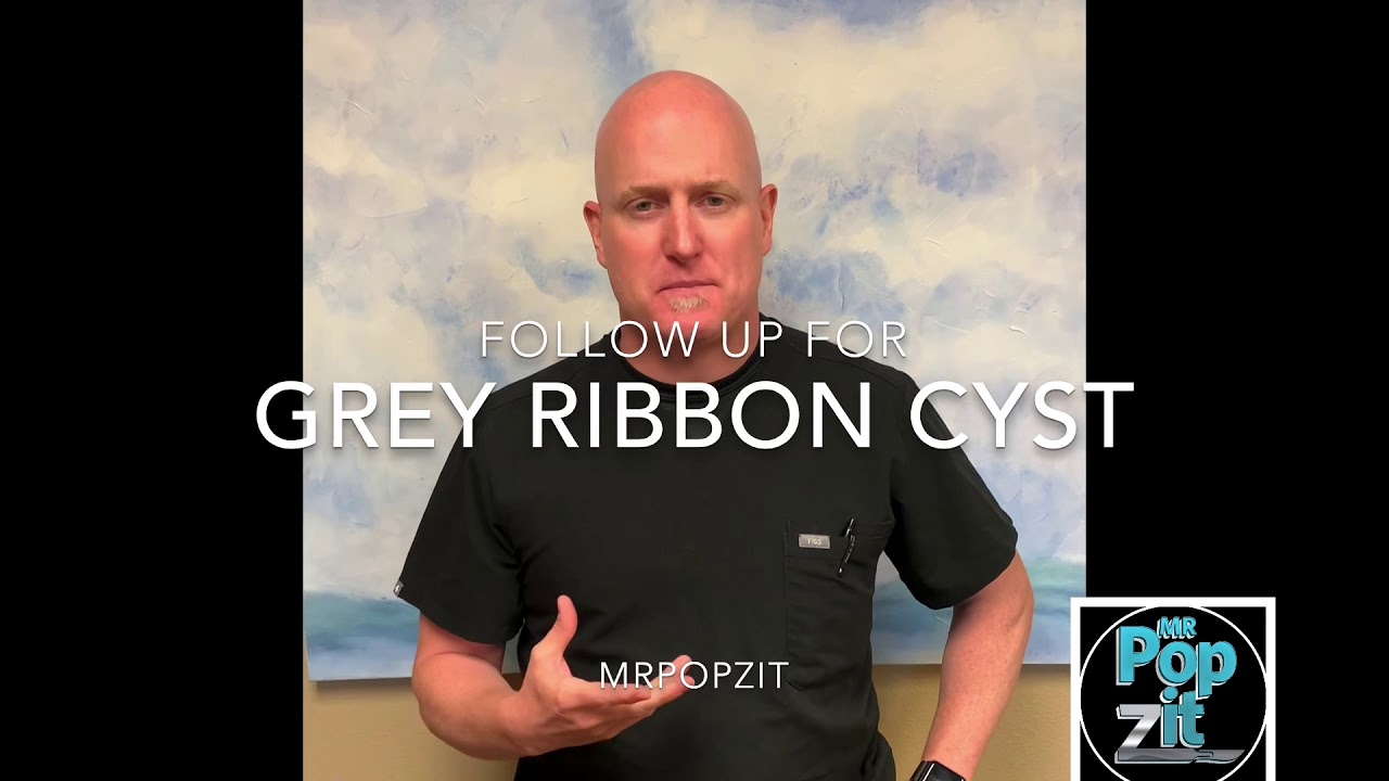 Grey ribbon armpit cyst follow up. Healed great. Patient very happy ...
