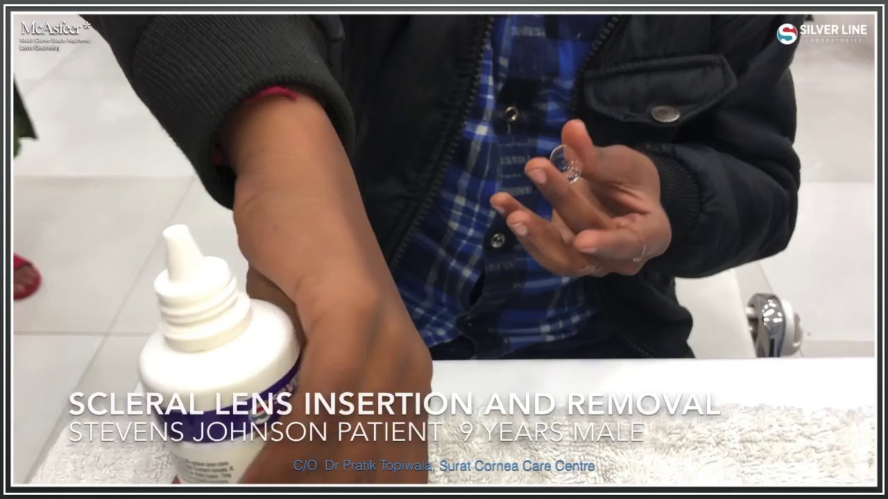 Scleral Lens Insertion and Removal - YouTube