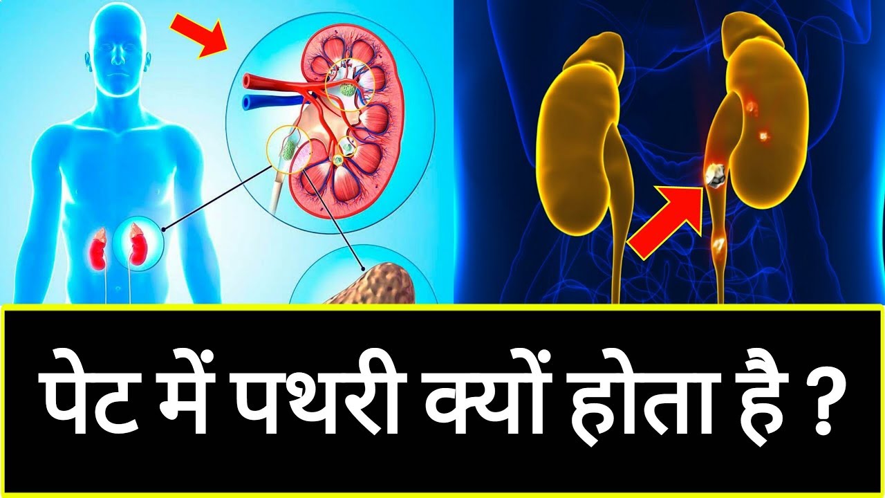 Interesting Fact : पेट में पथरी क्यों होता है || pet me pathri kyu hota ...