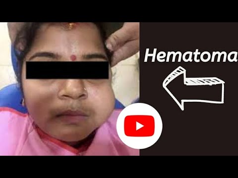 Management of hematoma due to local anesthesia - YouTube